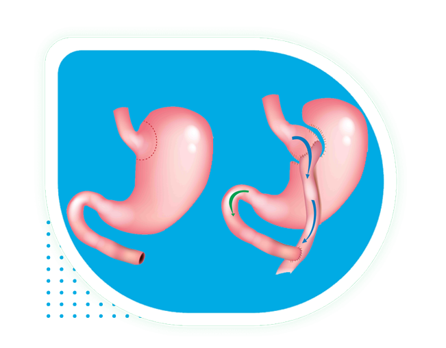 Dr. Marco Schulz Cirugia Bariatrica, Bypass, Manga, Bono Pad